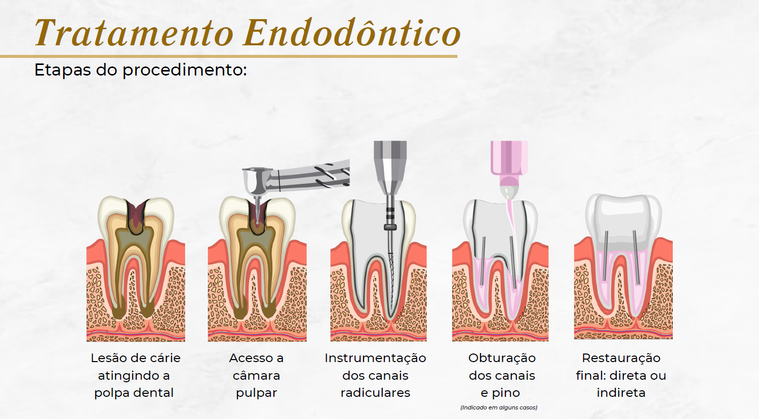 O Que é o Tratamento de Canal e Por Que Ele é Importante?